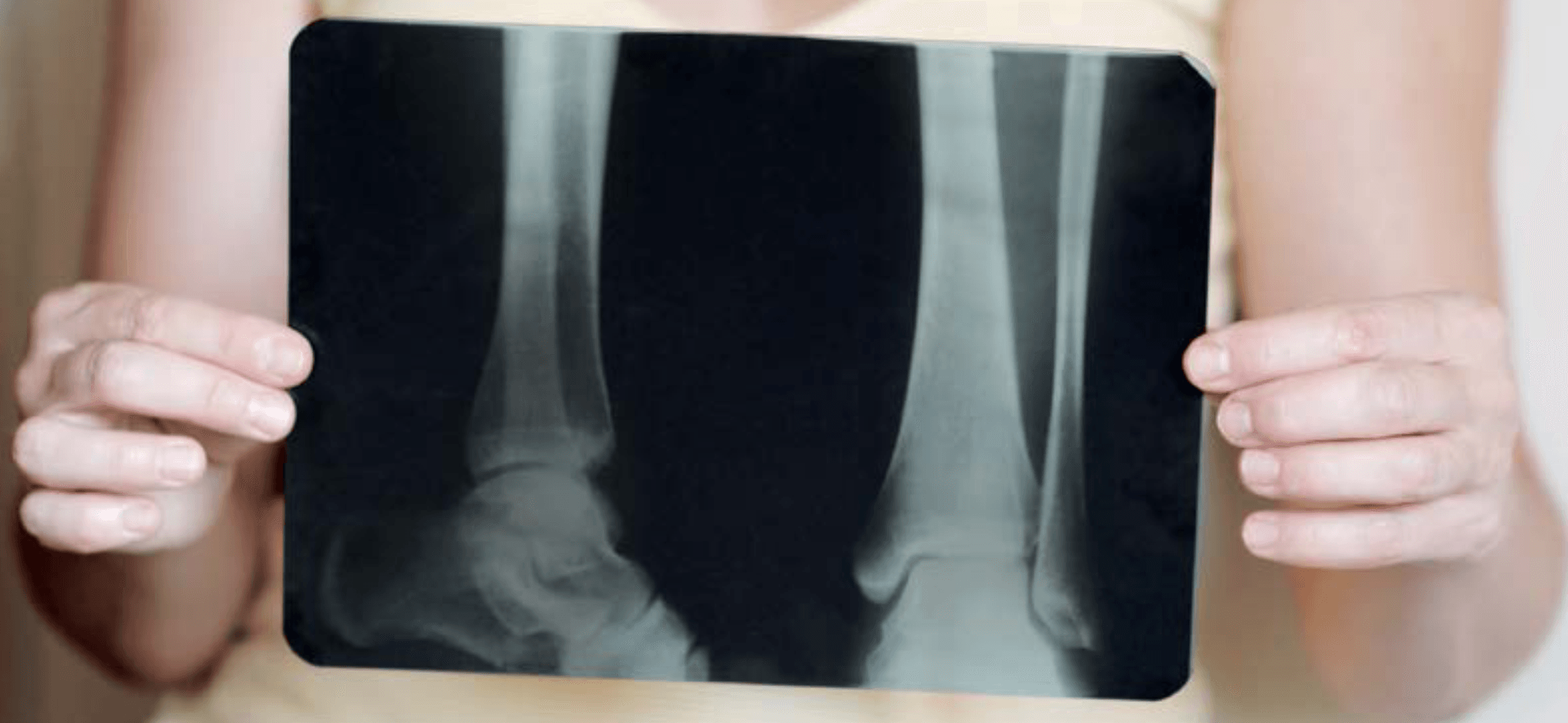 OSTEOPOROZA - JAK SOBIE Z NIĄ RADZIĆ? - Ziko dla zdrowia