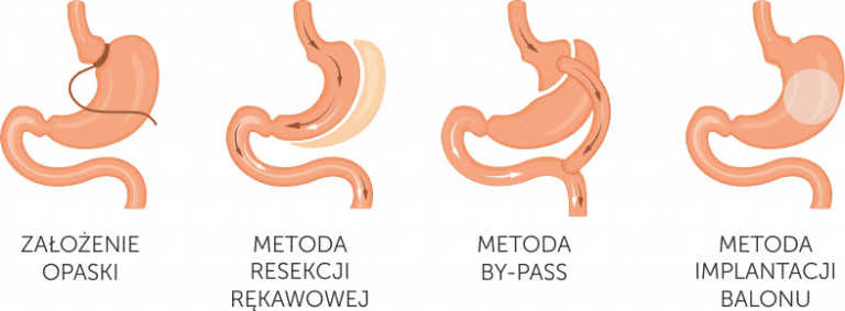Zmniejszenie żołądka - kiedy jest niezbędne i na czym polega? - Ziko ...